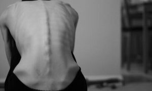 Признаци на анорексия - Психотерапевтична практика Вега